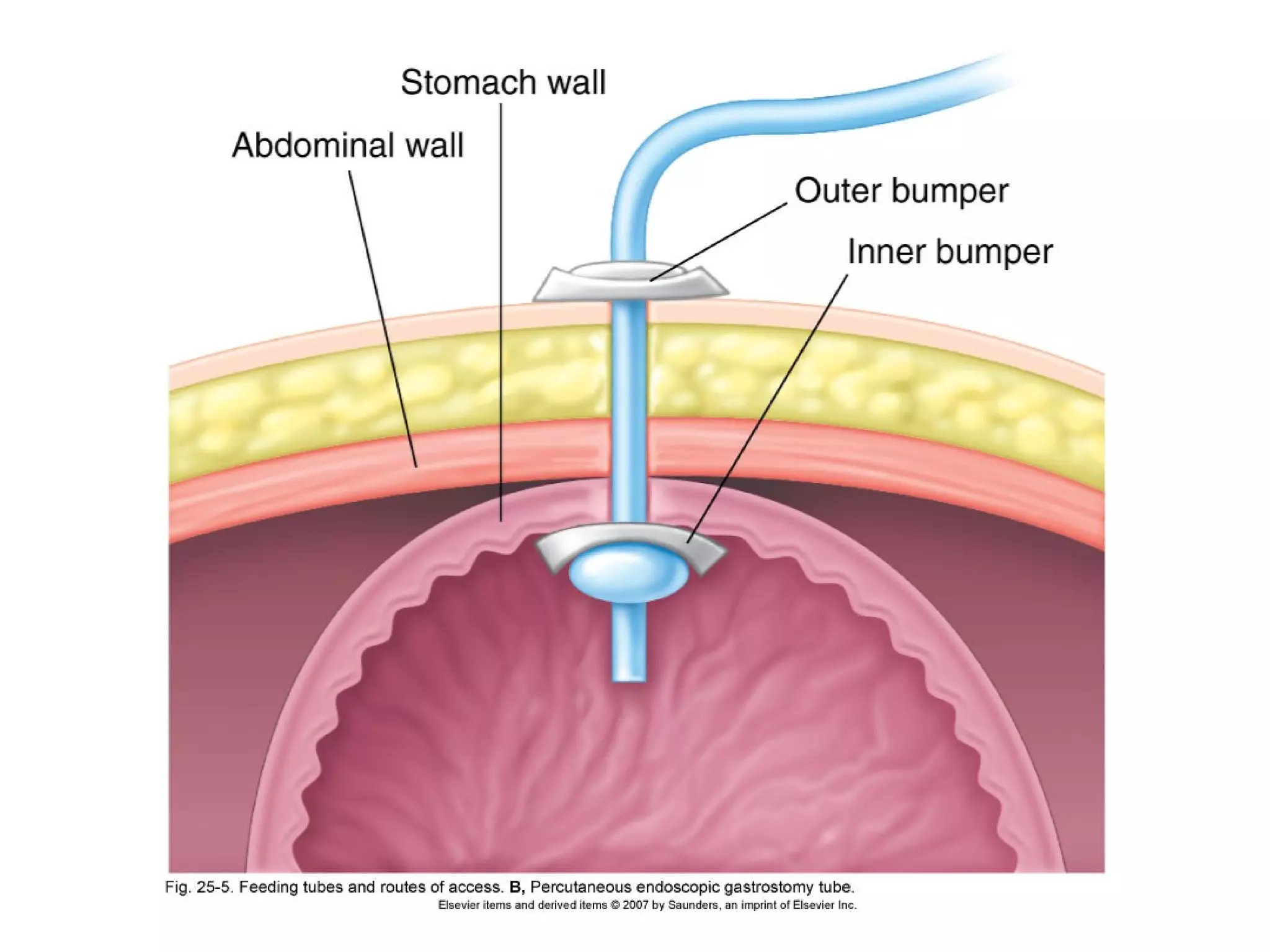 Ng And Peg Tubes Overview Chapter 25 | PPT | Surgery | Medical Health