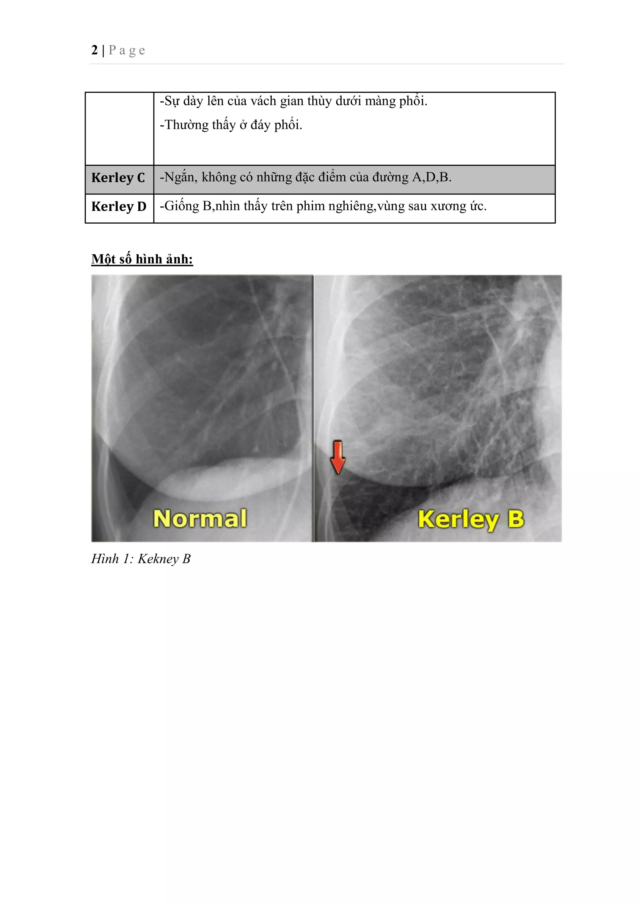 các đường kerley trong x-quang phổi | PDF