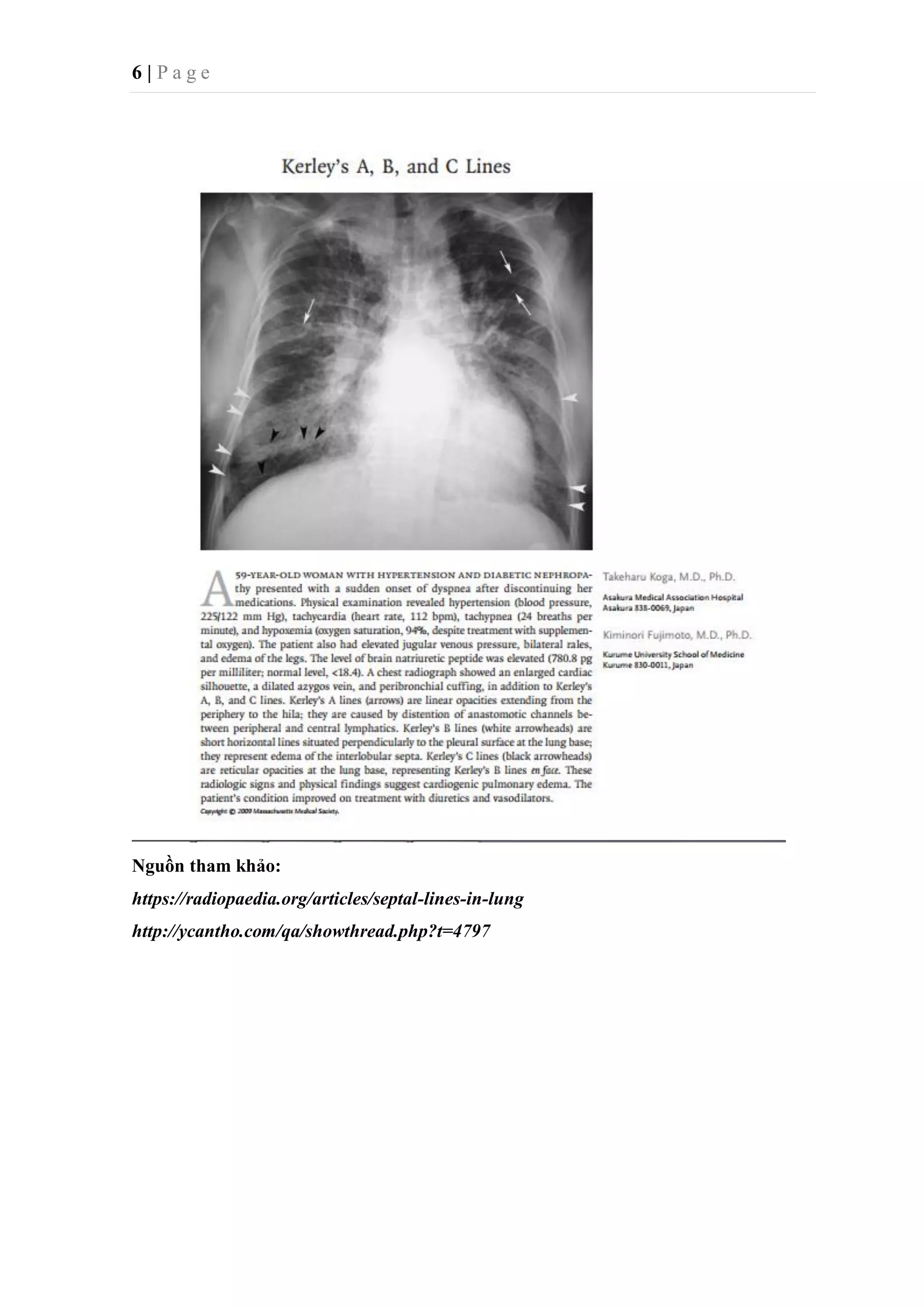 các đường kerley trong x-quang phổi | PDF