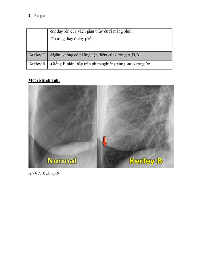 các đường kerley trong x-quang phổi | PDF