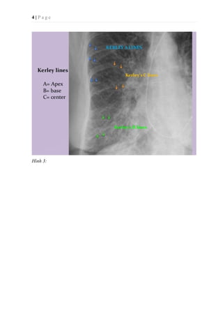 các đường kerley trong x-quang phổi | PDF
