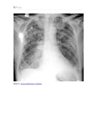 các đường kerley trong x-quang phổi | PDF