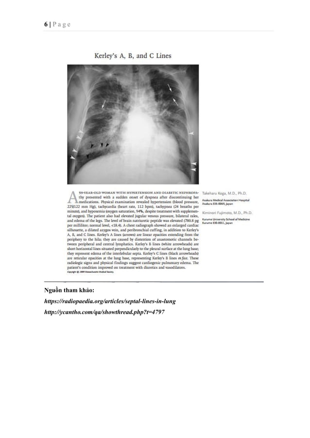 các đường kerley trong x-quang phổi | PDF