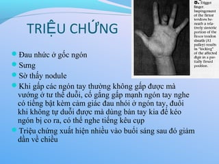 Ngón tay cò súng.pdf