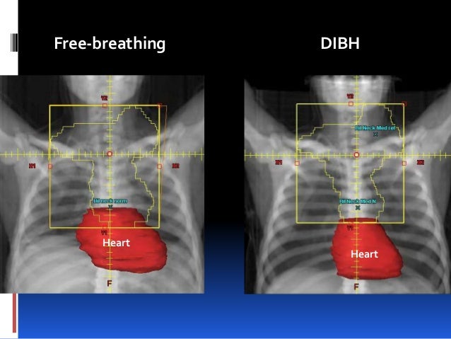 How Radiation Therapy Is Used in the Treatment of Lymphoma