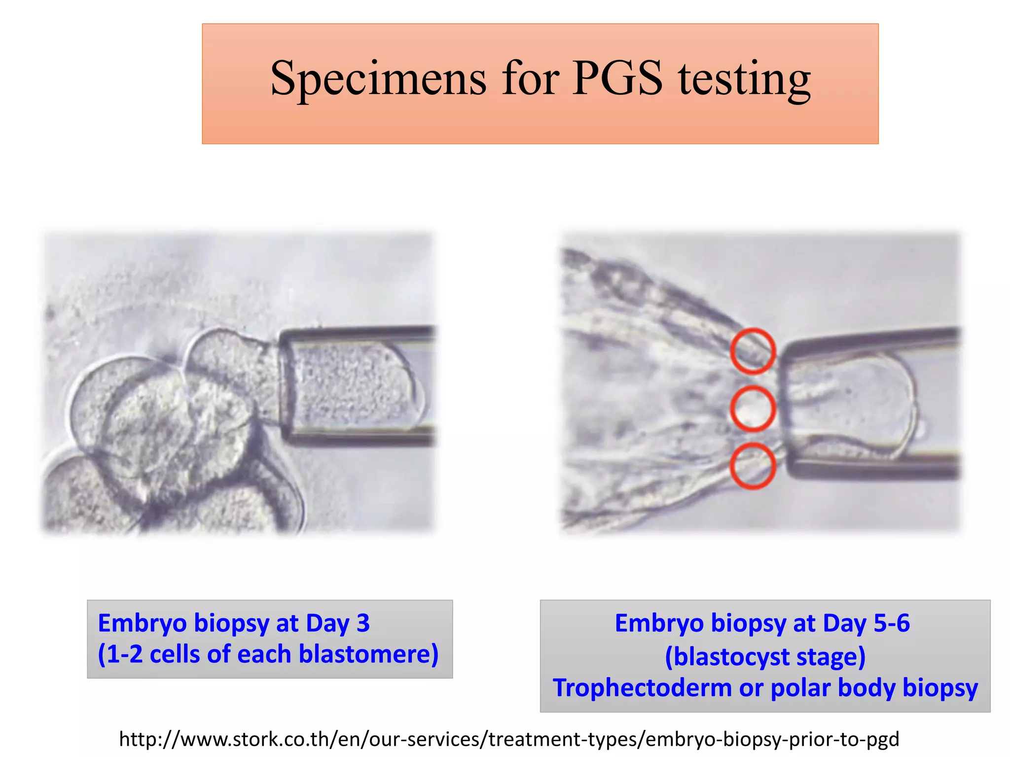 Next generation sequencing in preimplantation genetic screening (NGS in PGS) | PDF