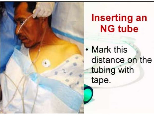 NASO GASTRIC TUBE INSERTION AND REMOVAL | PPT