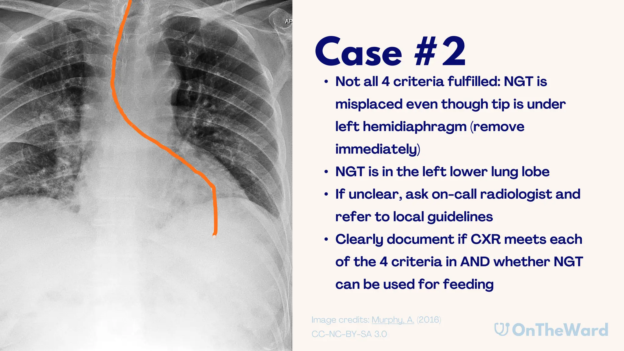 NGT Positioning on CXRs PowerPoint (OnTheWard) | PDF