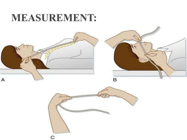 Nasogastric tube (NG tube) | PPTX | Ear, Nose and Throat Conditions | Diseases and Conditions