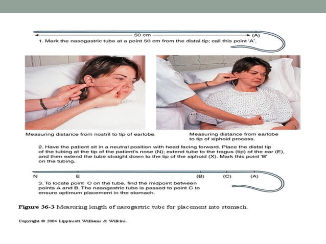 NG tube nursing application and types.pptx