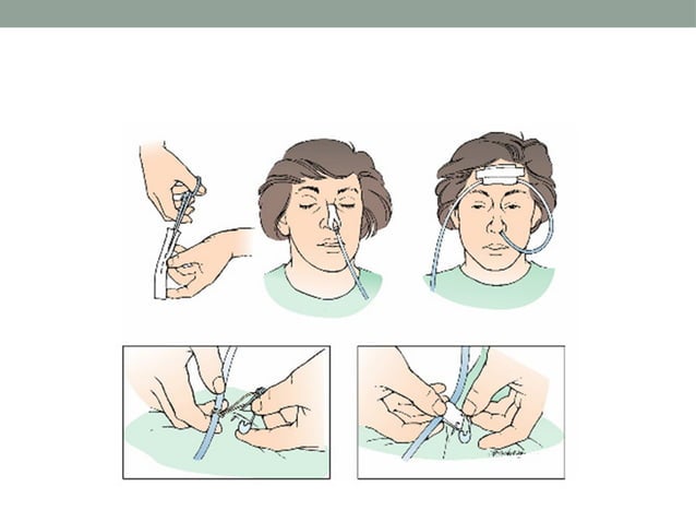 NG tube nursing application and types.pptx