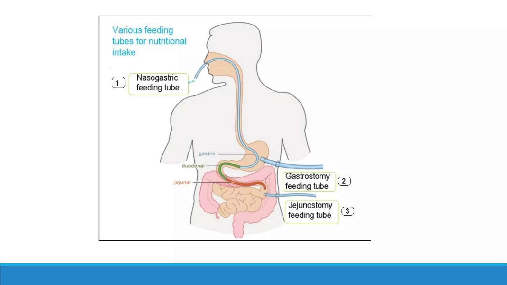 Ng tube feeding | PPTX