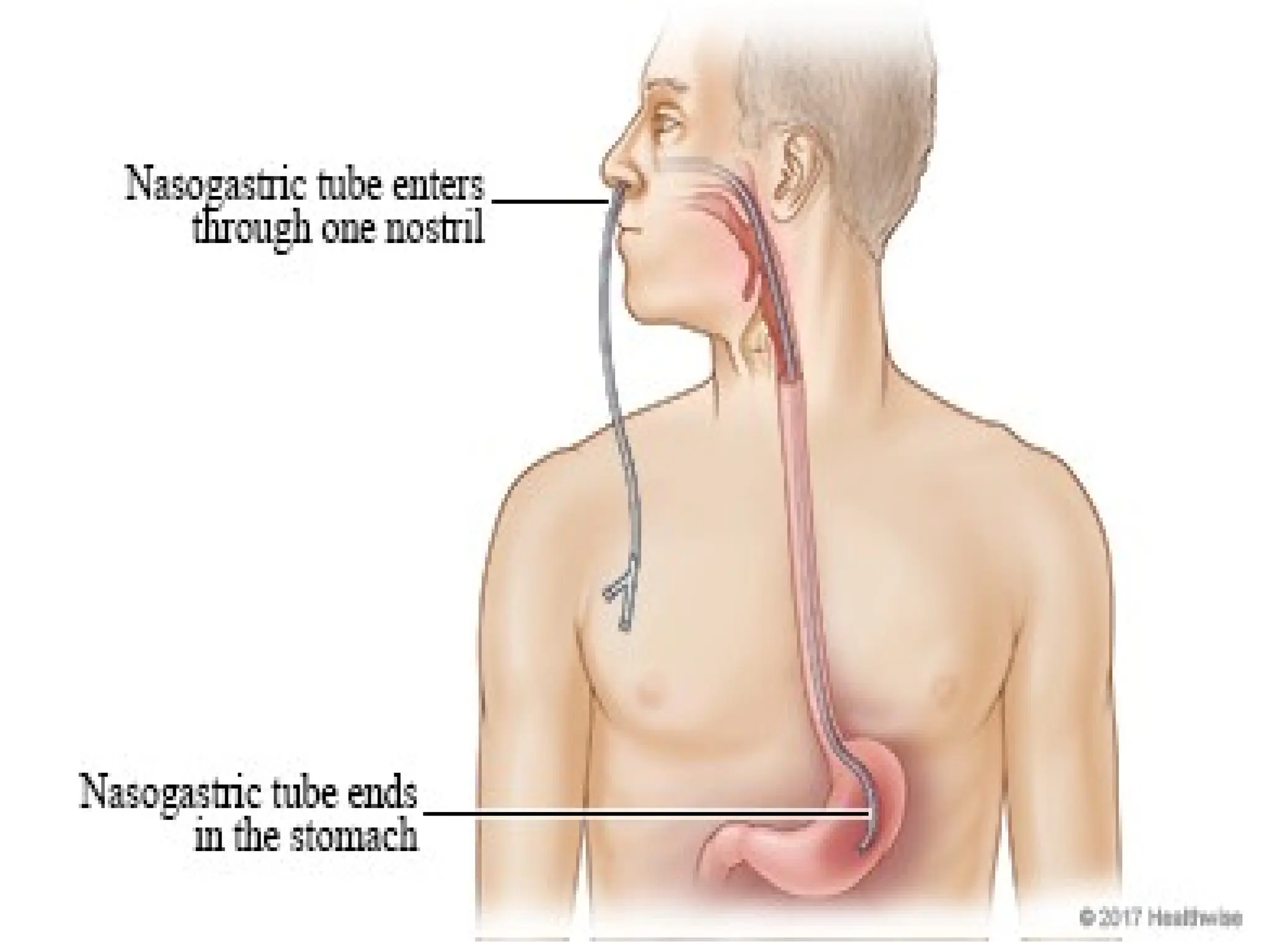 NG Tube Feeding.pptxRYLES TUBE FFEDING PROCEDURE | PPTX