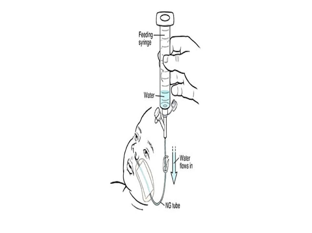 NG Tube Feeding.pptxRYLES TUBE FFEDING PROCEDURE | PPTX