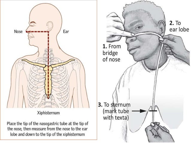 NG Tube Feeding.pptxRYLES TUBE FFEDING PROCEDURE | PPTX