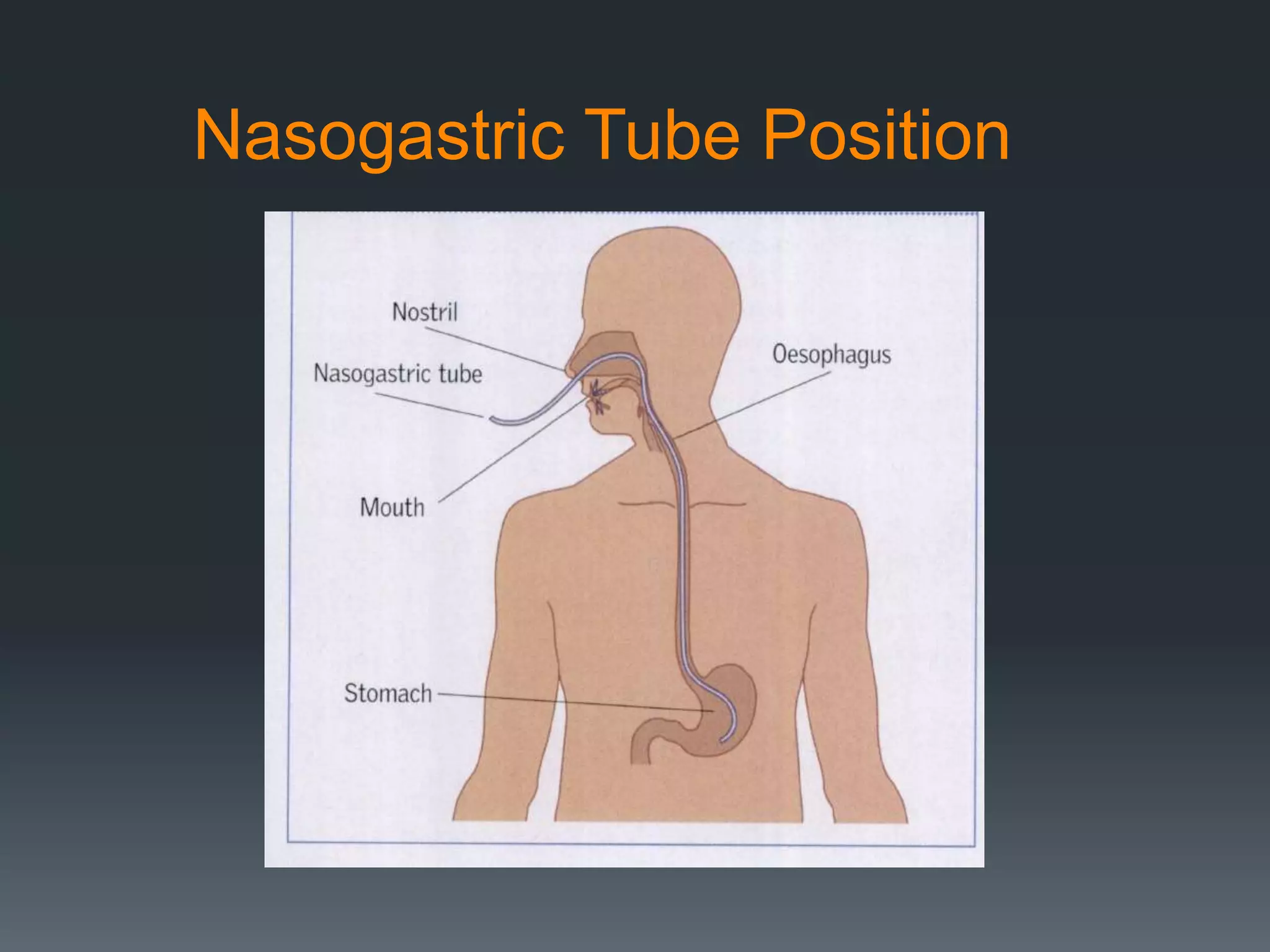 Ng tube insertion & feeding, CAREOFNG TUBE SHIVA NAGU | PPT