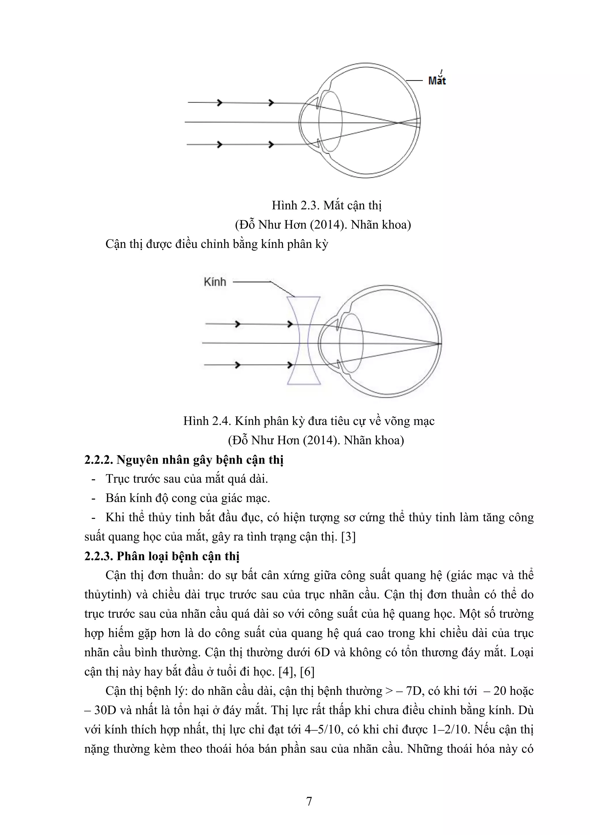 Đề tài: Khảo sát kiến thức về bệnh cận thị của học sinh khối 12 | PDF
