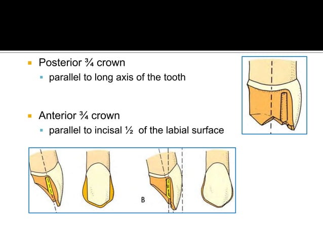 Nguyen tac chuan bi rang trong veneer | PPT