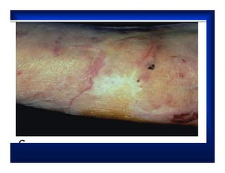 NGUYÊN TẮC SỬ DỤNG CORTICOID.pdf