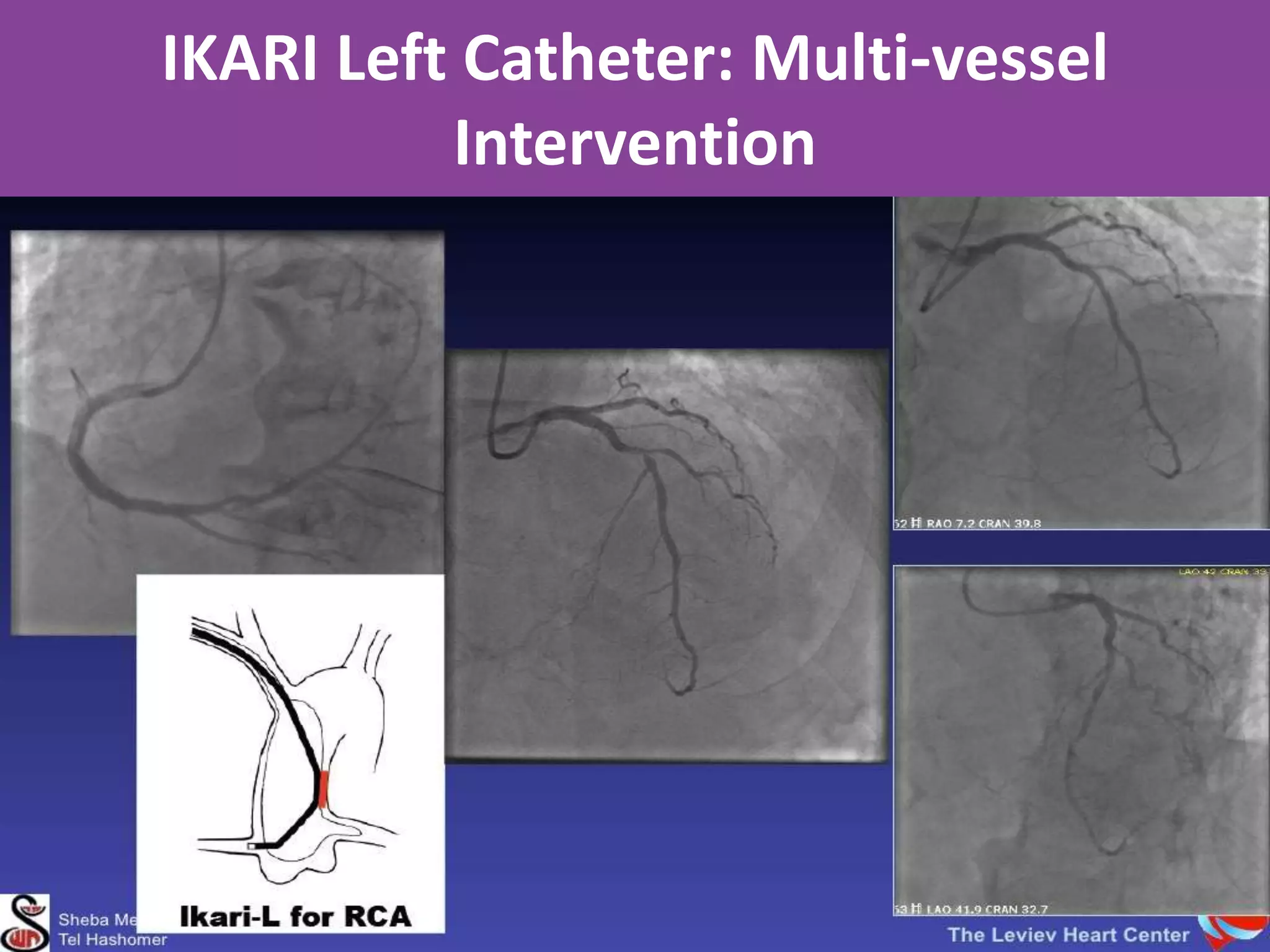 Challenges of Radial Access-Anatomy, Tools and Success | PPT