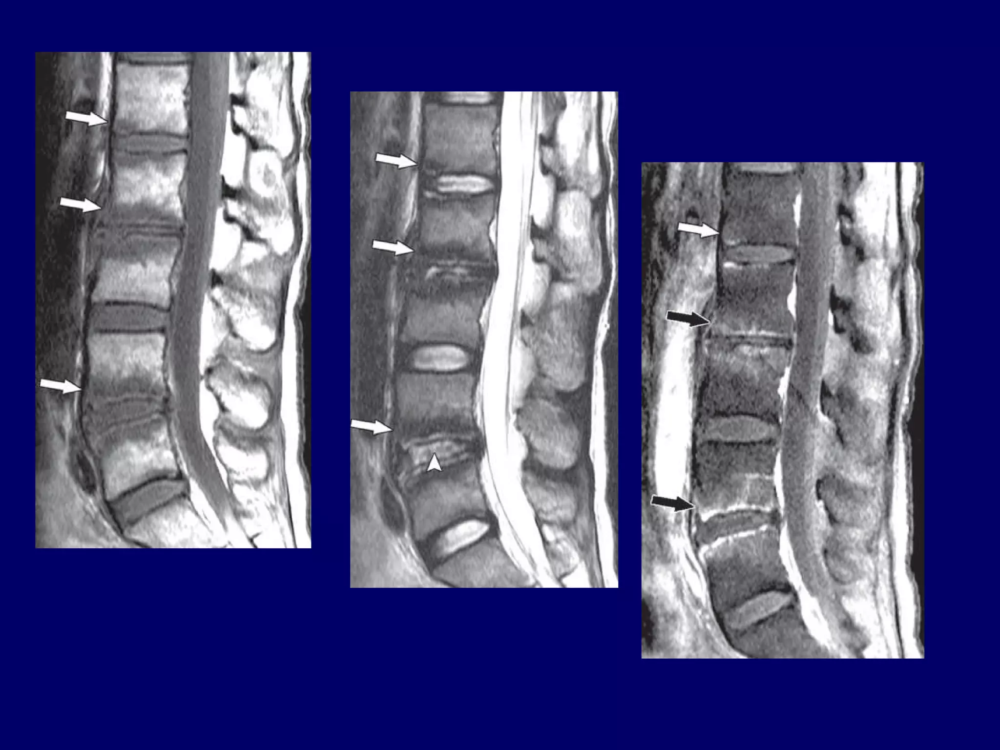 Hinh anh MRI cot song | PPT