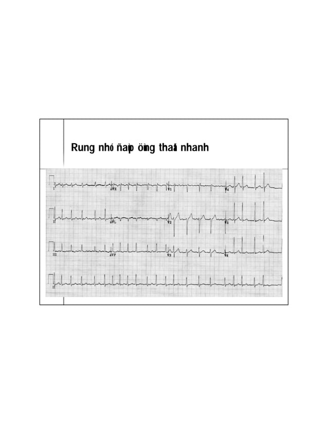 NHỊP NHANH VỚI PHỨC BỘ QRS HẸP | PDF