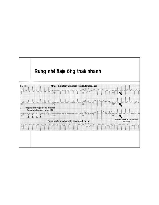 NHỊP NHANH VỚI PHỨC BỘ QRS HẸP | PDF