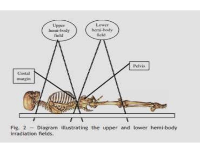 Hemi body irradiation