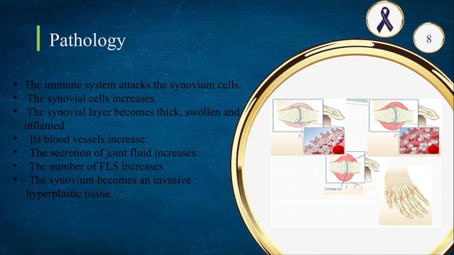 Rheumatoid Arthritis: Pathology, Etiology & Diagnosis (PPT & PDF ...