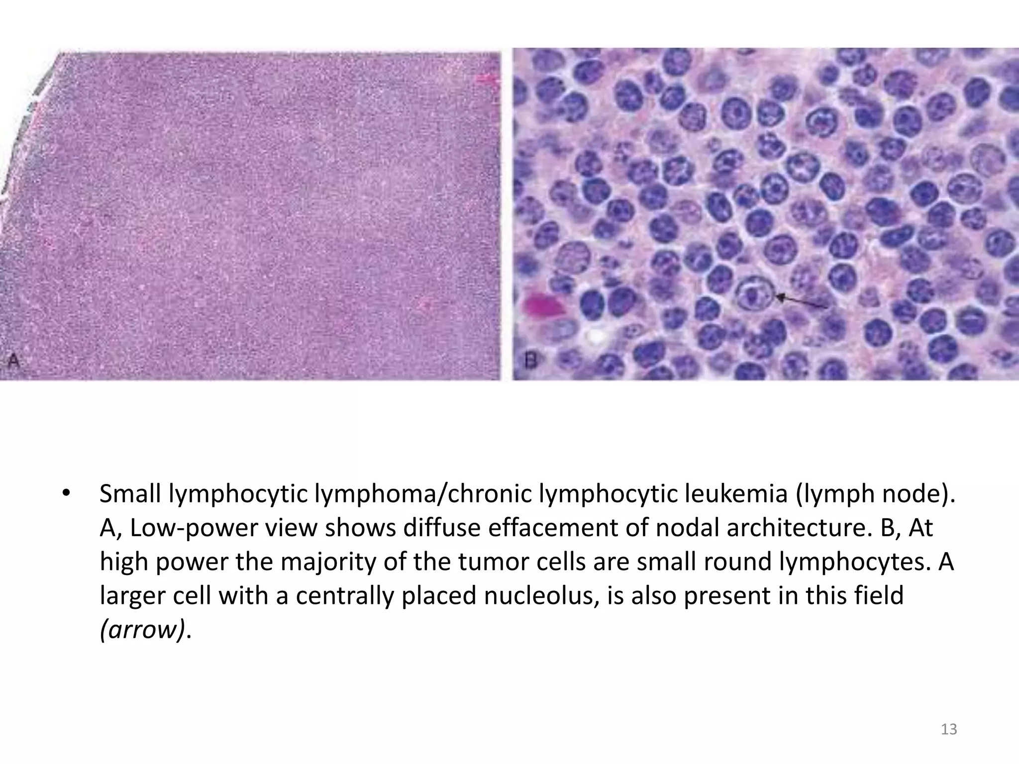 Non hodgkin lymphoma | PPTX