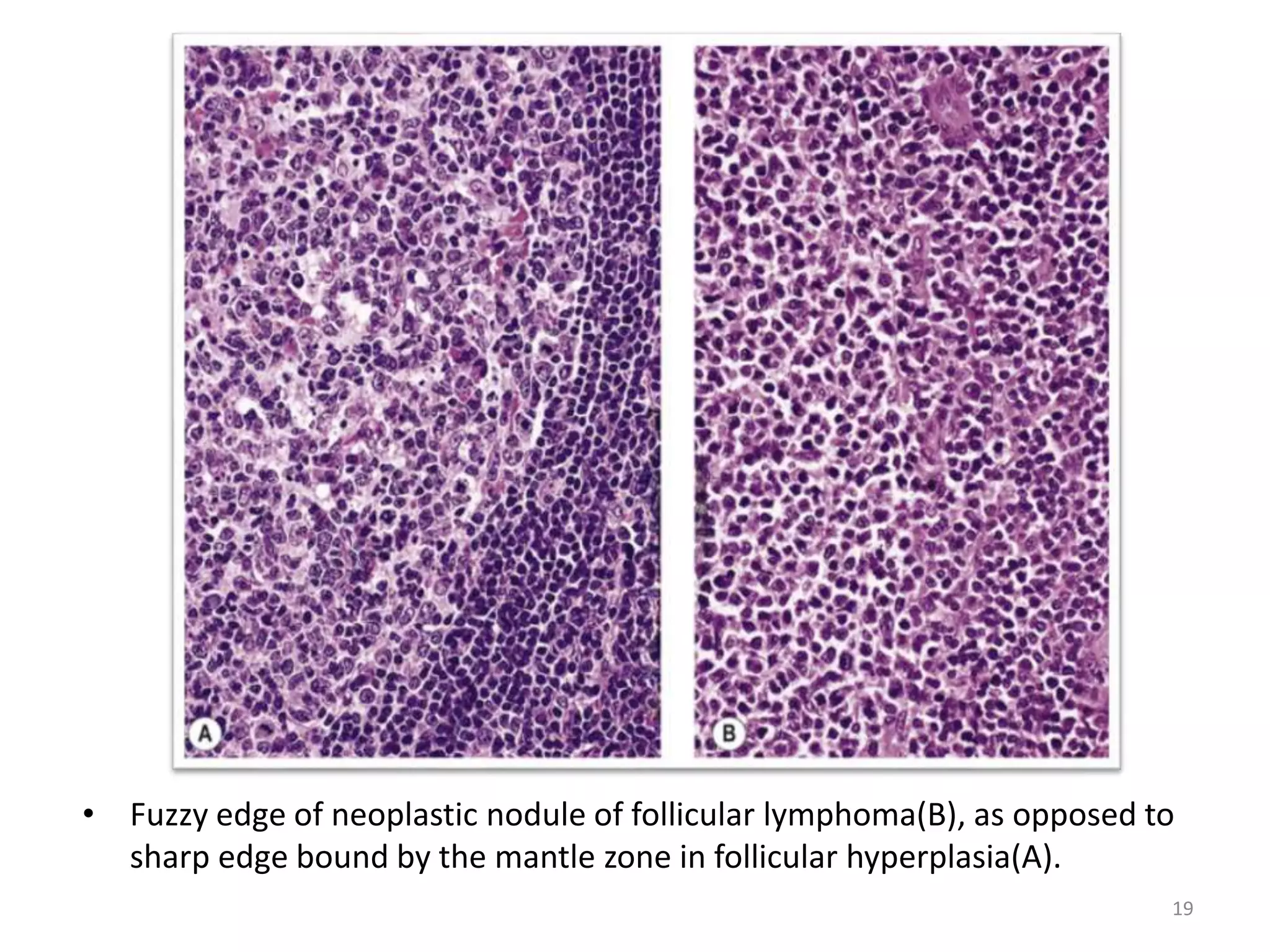 Non hodgkin lymphoma | PPTX