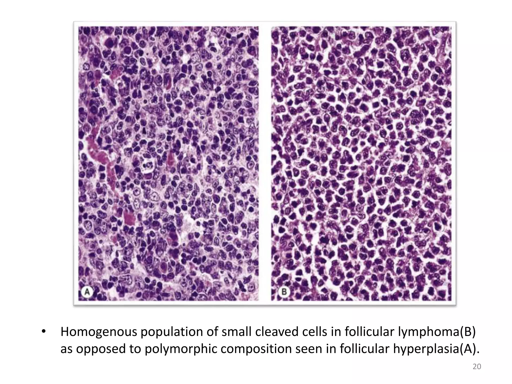 Non hodgkin lymphoma | PPTX