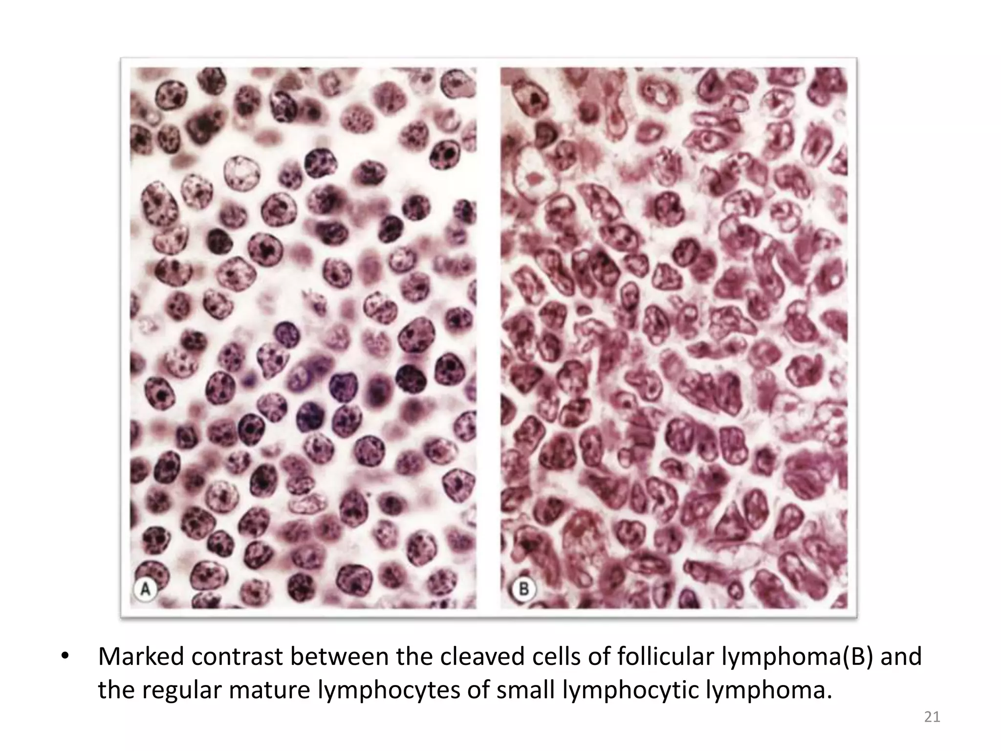 Non hodgkin lymphoma | PPTX