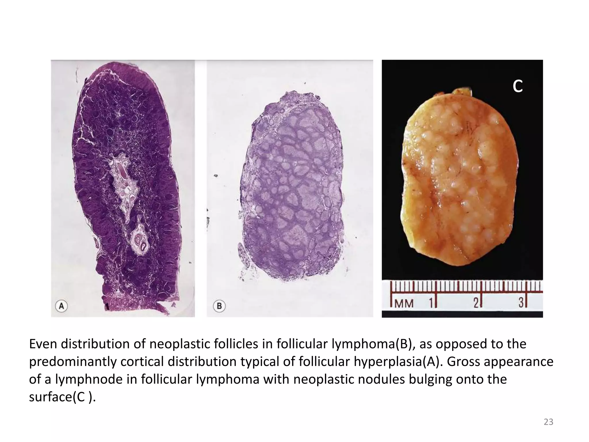 Non hodgkin lymphoma | PPTX