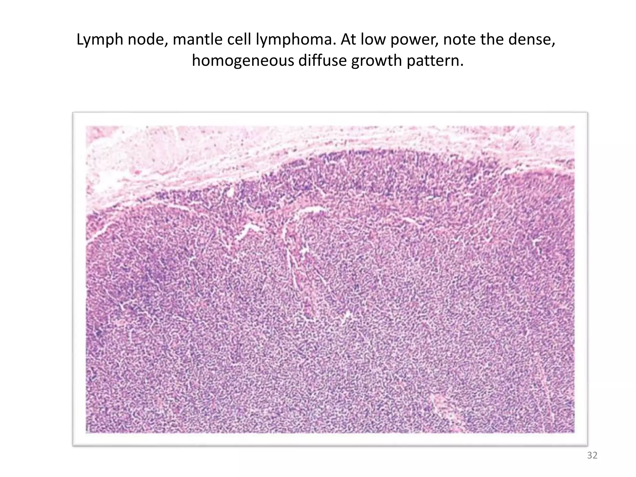 Non hodgkin lymphoma | PPTX