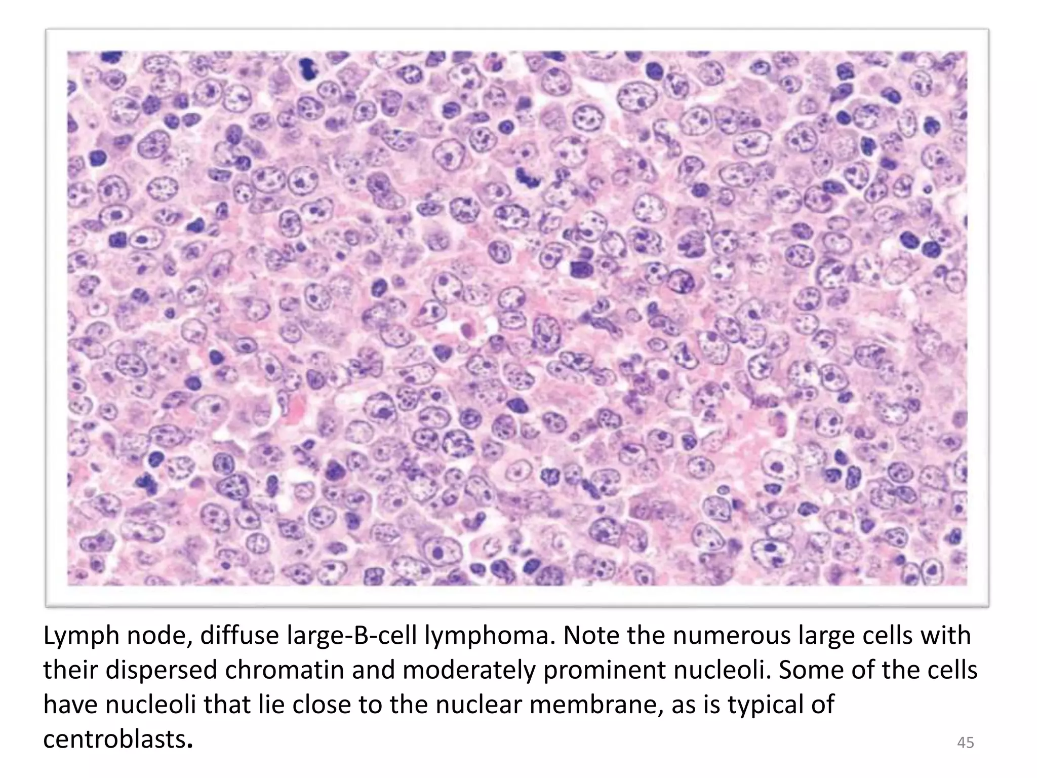 Non hodgkin lymphoma | PPTX