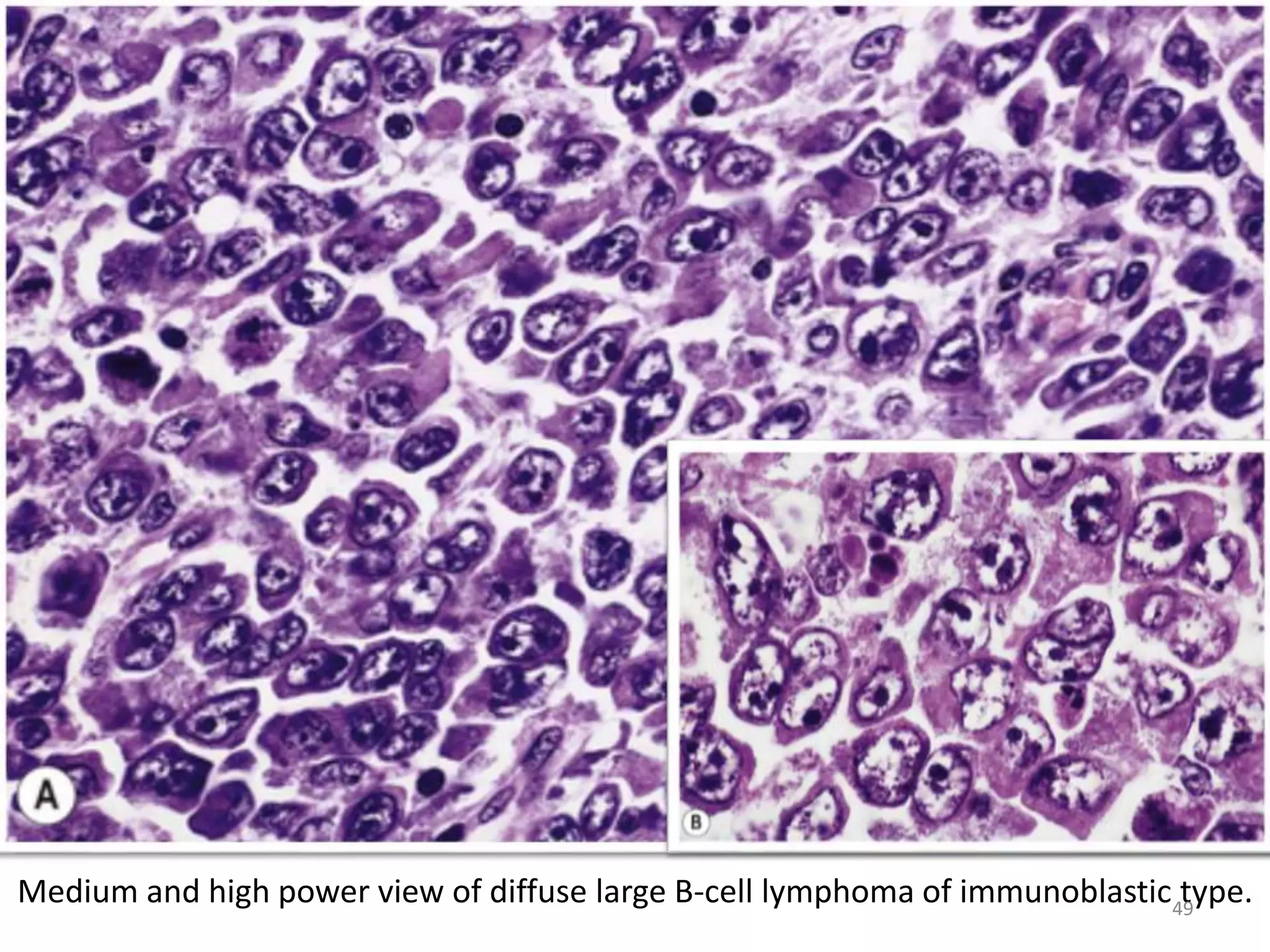 Non hodgkin lymphoma | PPTX