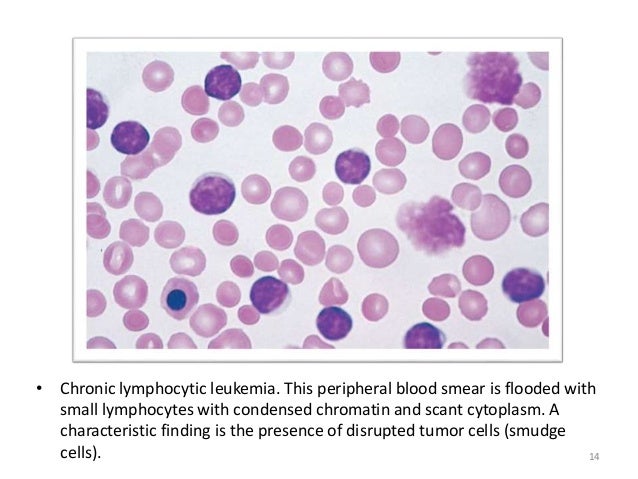 Non hodgkin lymphoma