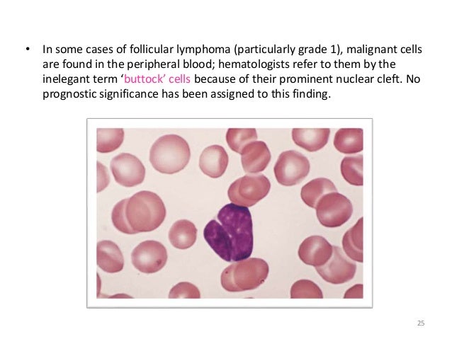 Non hodgkin lymphoma