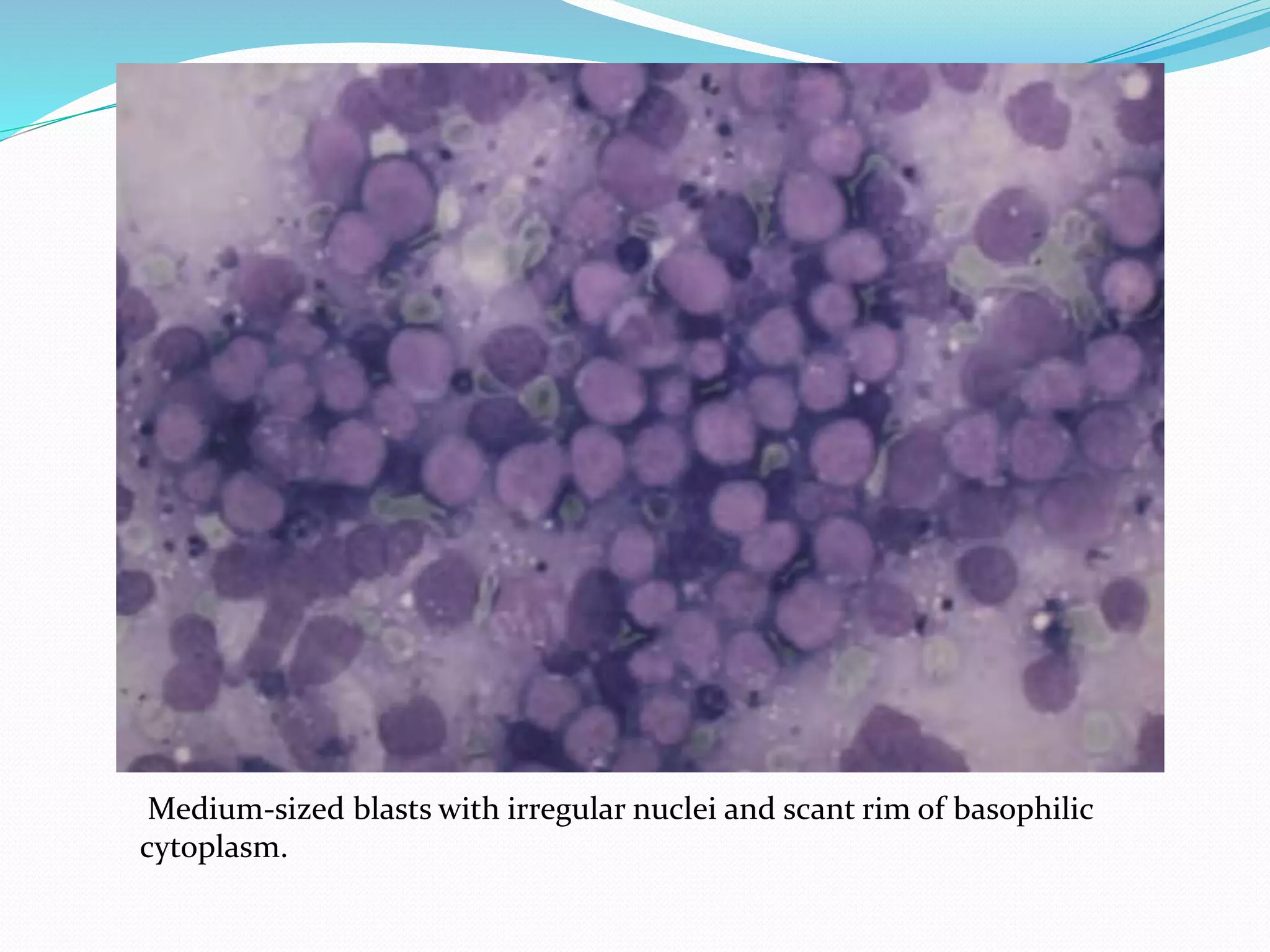 Non Hodgkin Lymphoma, cytology. | PPTX