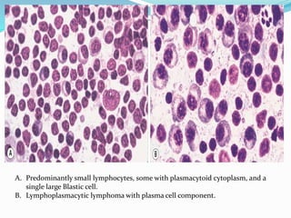 Non Hodgkin Lymphoma, cytology. | PPTX