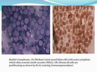 Non Hodgkin Lymphoma, cytology. | PPTX