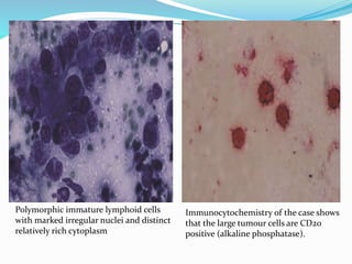 Non Hodgkin Lymphoma, cytology. | PPTX