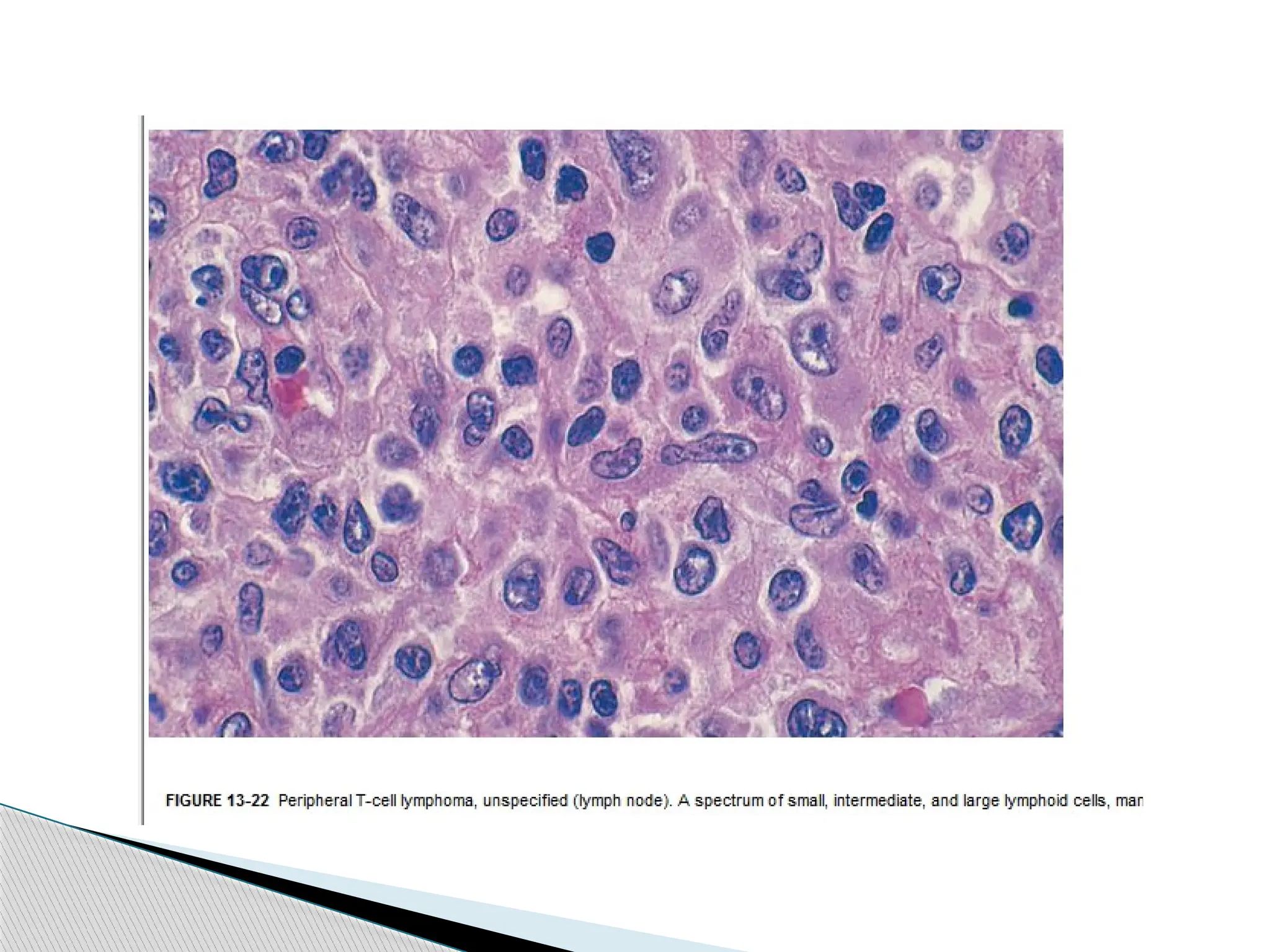 Non Hodgkin Lymphoma pathology pathology.pptx