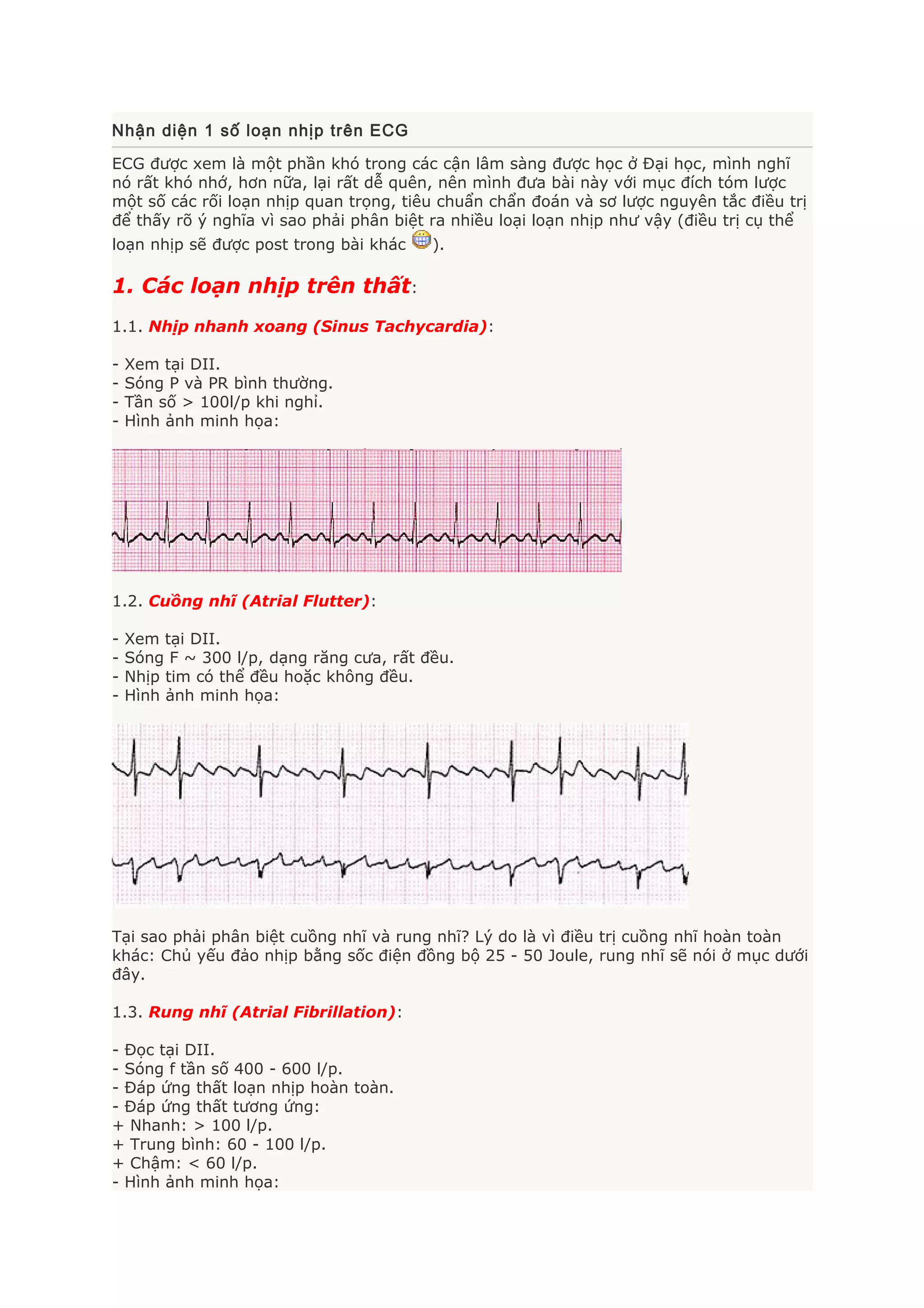 Nhận diện 1 số loạn nhịp trên ecg | DOC