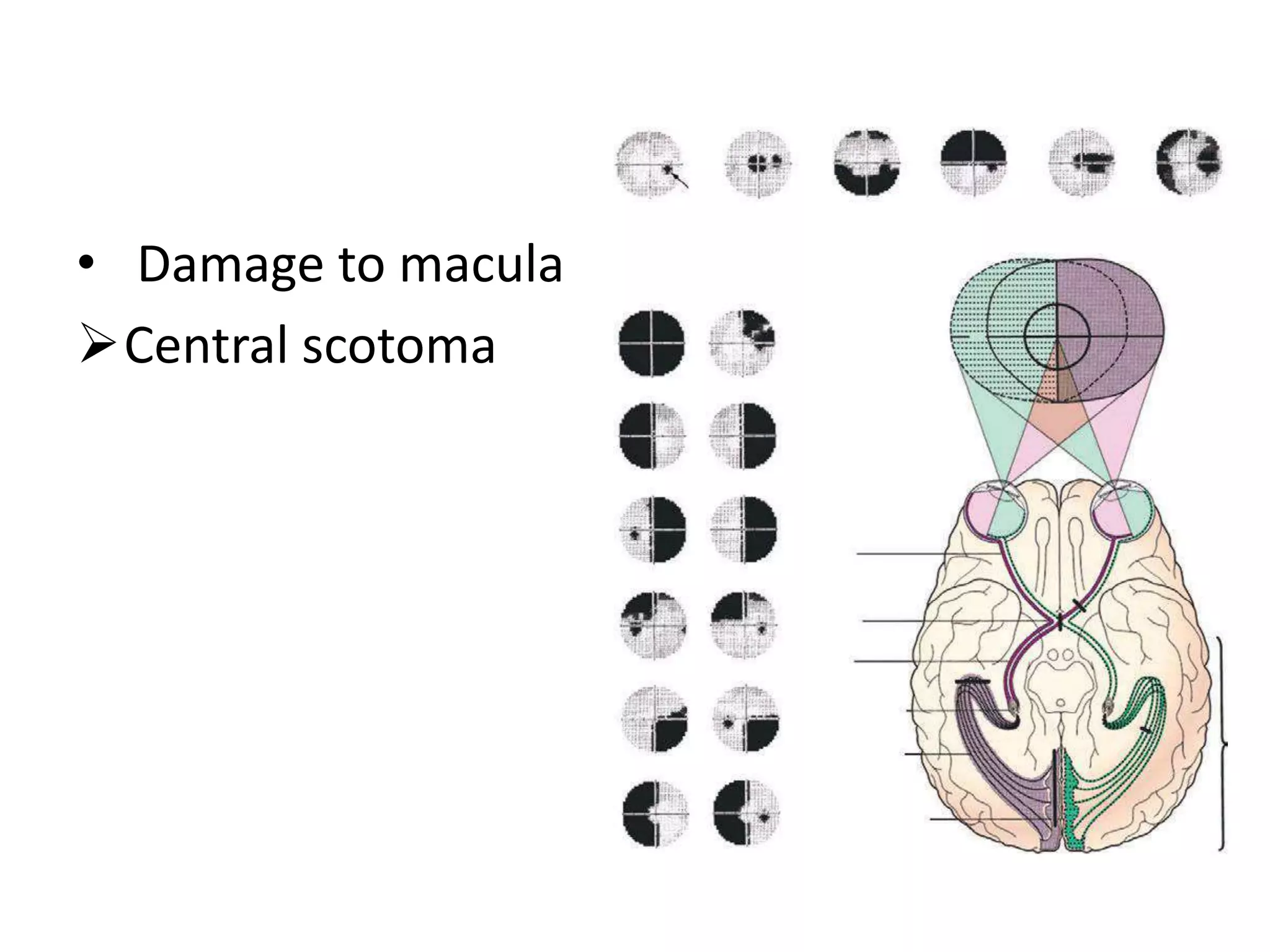 Visual field defects | PPTX