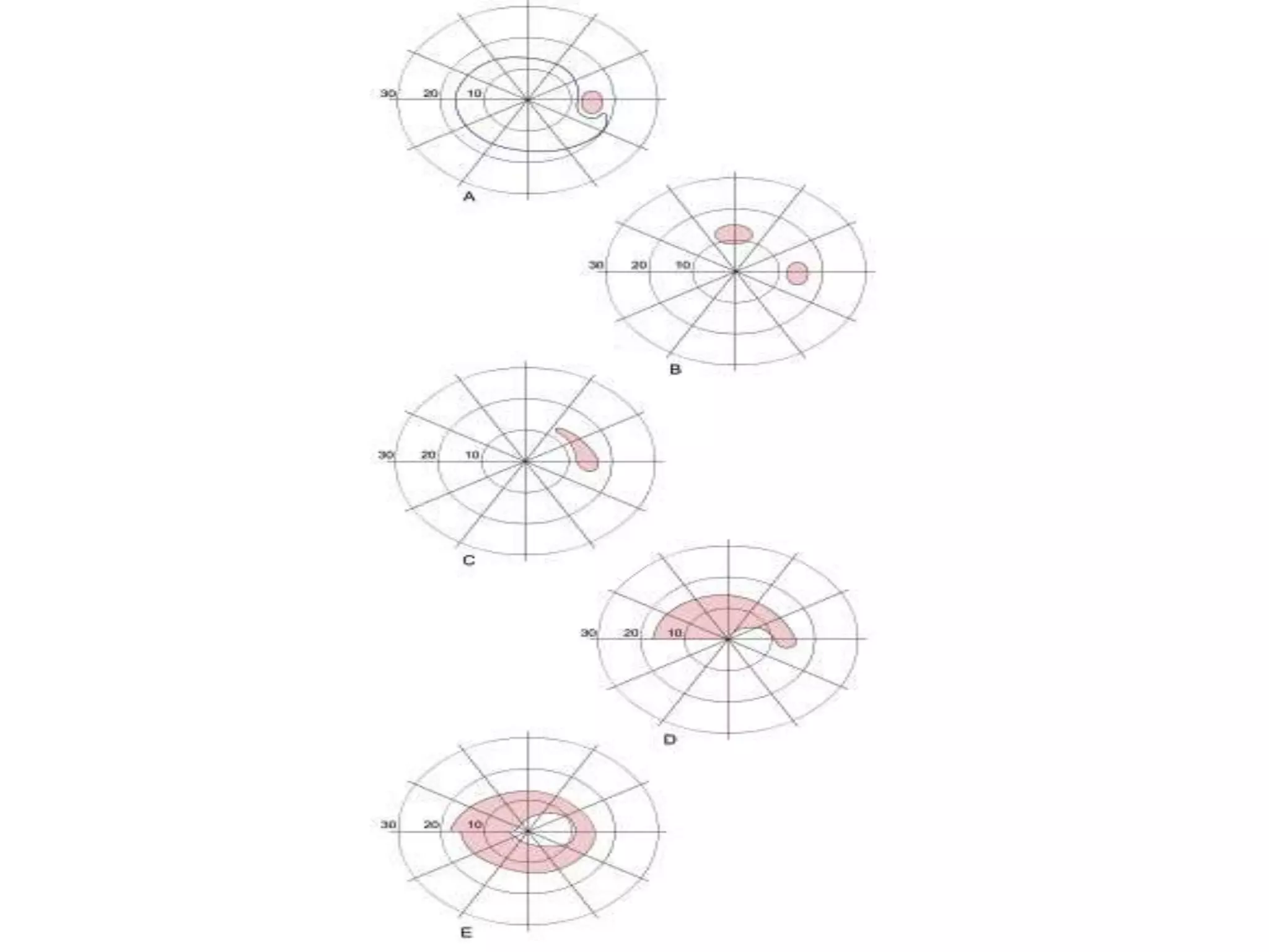 Visual field defects | PPTX