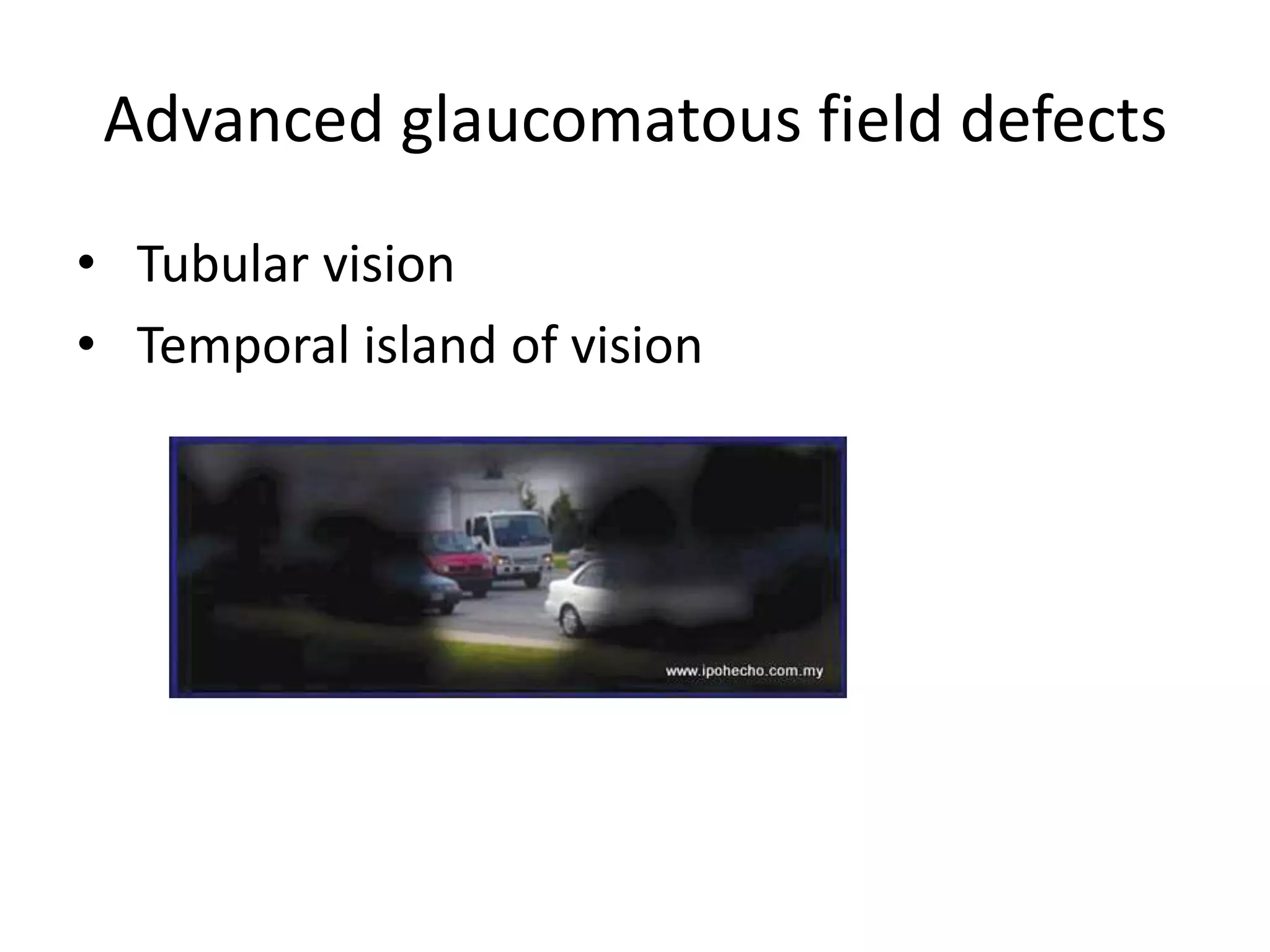 Visual field defects | PPTX