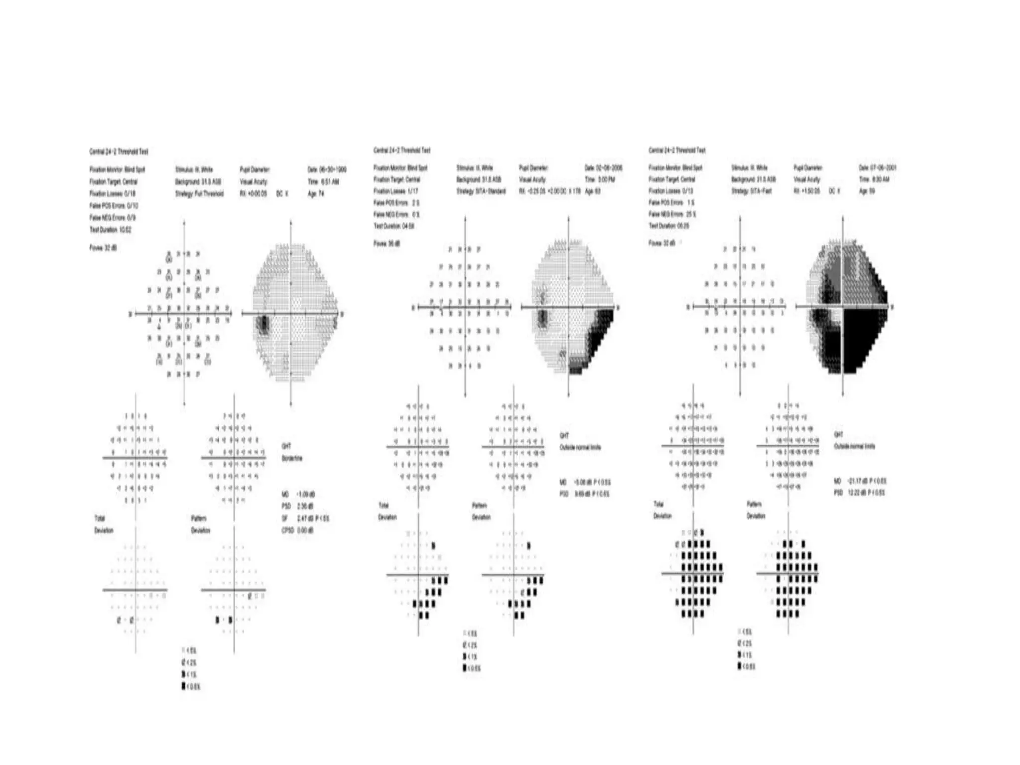 Visual field defects | PPTX