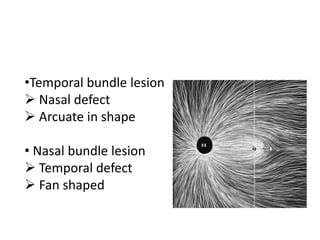Visual field defects | PPTX